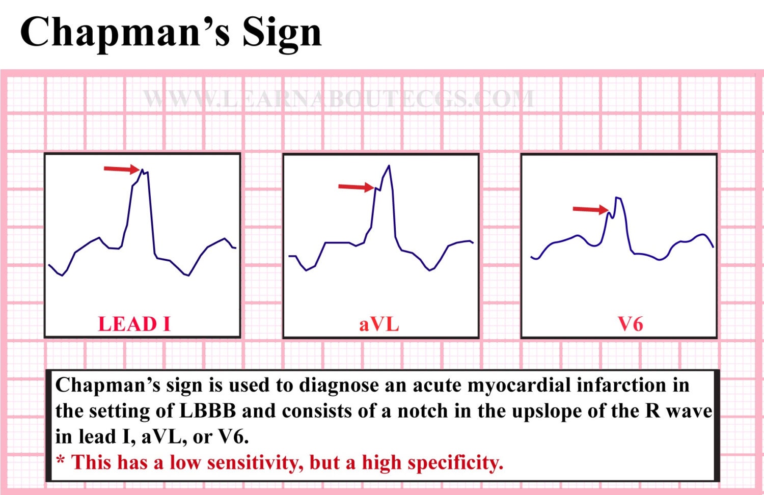 Chapman's Sign ECG by ELECTROCARDIOLOGY on Etsy