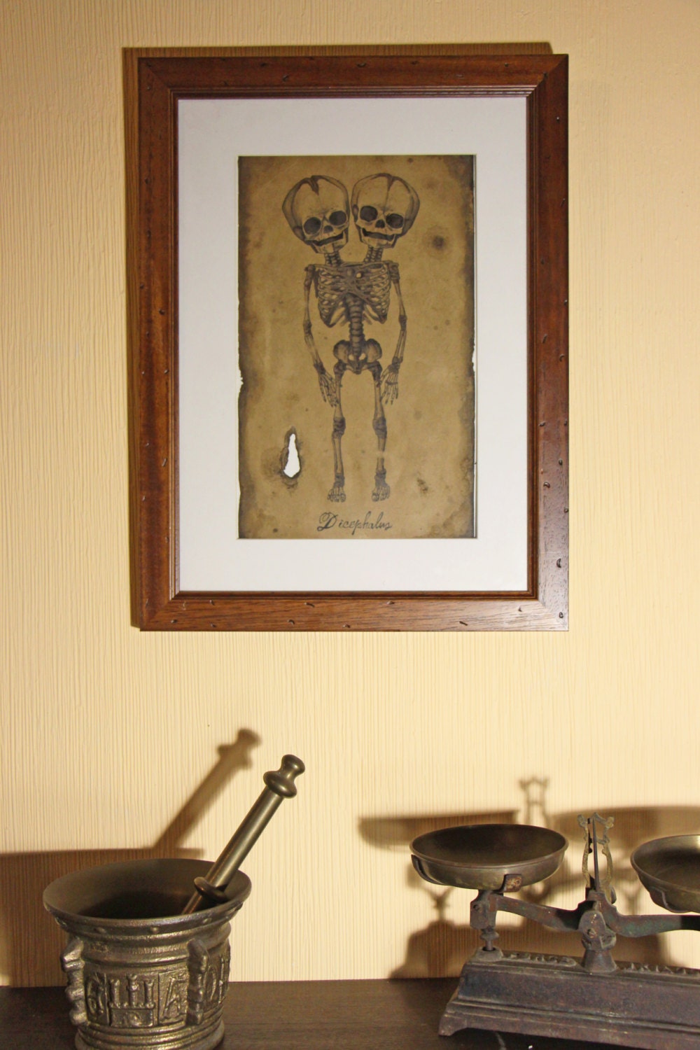 Conjoined twins skeleton Original drawing Medical by DrZierbo