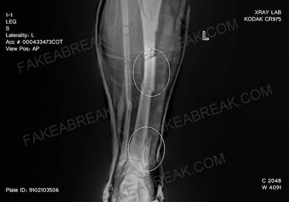 Fake broken leg X-Raygag giftfake a breakfake break
